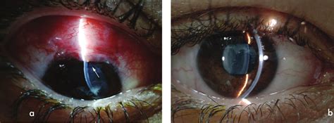 A One Day Postoperative Appearance Of The Right Eye Shows A