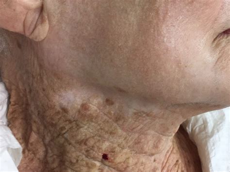A 92 Year Old Used Sunscreen On Her Face But Not Her Neck For More Than
