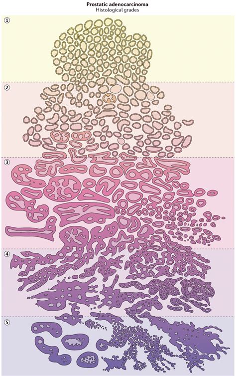 The Prostate Cancer Grading And Scoring System Developed By Gleason Download Scientific