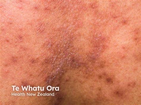 Pruritic Papular Eruption