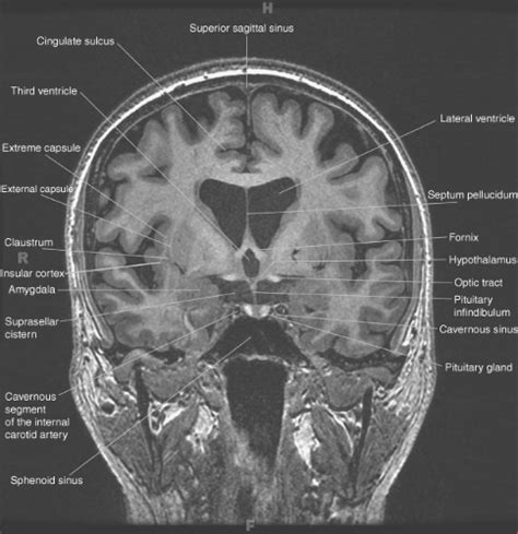 Suprasellar Cistern Anatomy