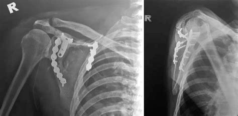Postoperative Right Shoulder Anteroposterior And Y Scapular View Download Scientific Diagram