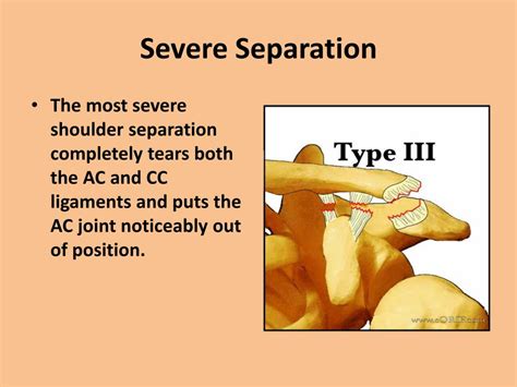 Ppt Understanding Shoulder Separations Types Symptoms And
