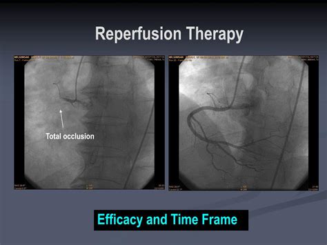 PPT Treatment Of STEMI Mechanical Reperfusion Therapy PowerPoint