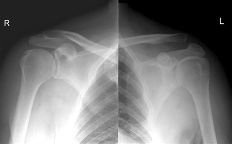 Acromioclavicular Joint Separation