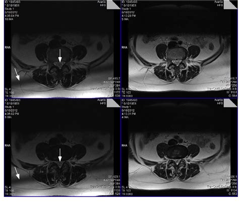 Figure 3 From Elimination Of Motion Pulsatile Flow And Cross Talk Artifacts Using Blade