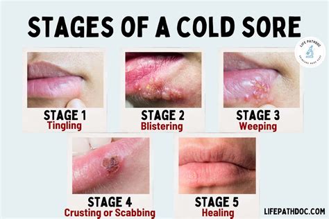 Cold Sore Stages With Pictures