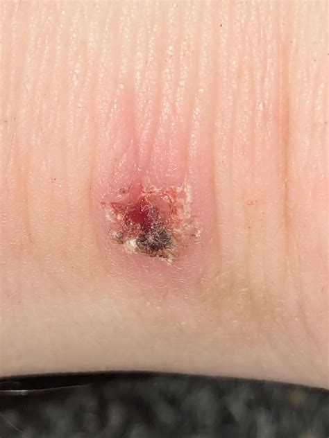 Is This Infected Rscabies