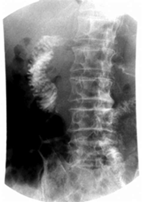 Preoperative Gastrografin Meal Showing A Dilated Proximal Duodenum With