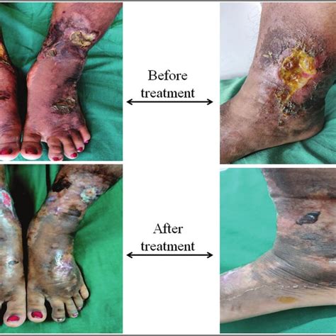 Case 1 A And B Multiple Ulcers Having Well Defined Borders Sloping Download Scientific