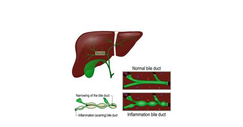 Bile Duct Inflammation And Scarring Causes Diagnosis And Treatments