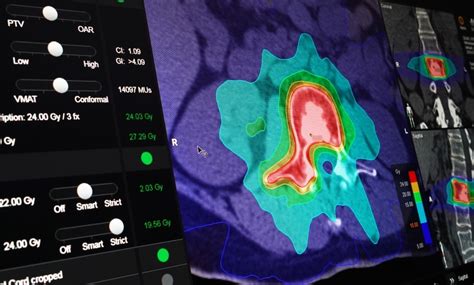 Fda Greenlights Brainlabs Radiosurgery Planning Software Fiercebiotech