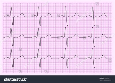 Ecg Results Over 240 Royalty Free Licensable Stock Vectors And Vector
