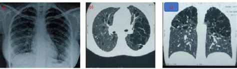 A C 2a Chest Radiograph Shows Clearing Of Reticulonodular Infiltrates Download Scientific