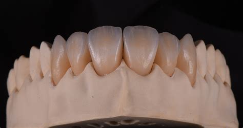 A Guide To Perfectly Polished Composite Restorations