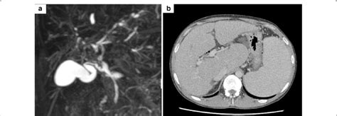 The Imaging Findings Of Primary Sclerosing Cholangitis PSC Are Shown Download Scientific