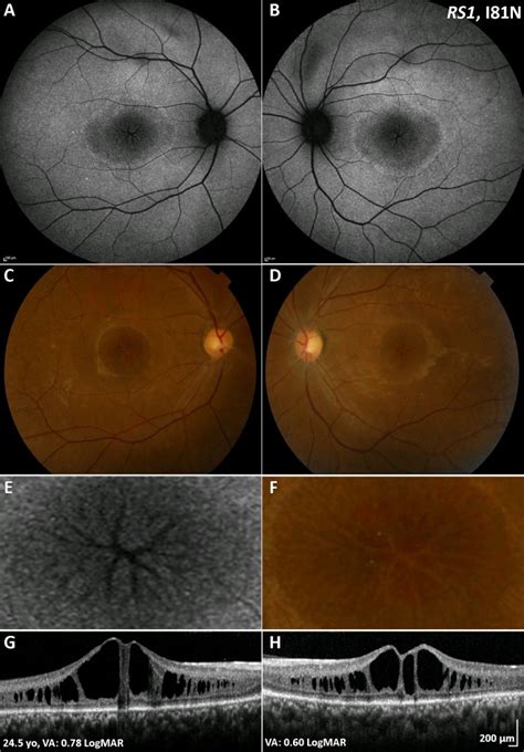 Macular Dystrophies Clinical And Imaging Features Molecular Genetics