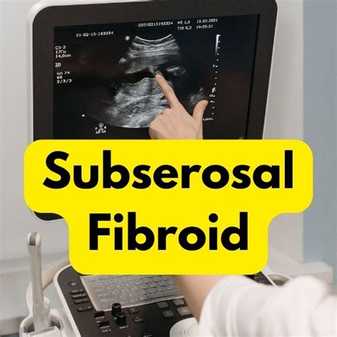 Subserosal Fibroid The Nurse Page