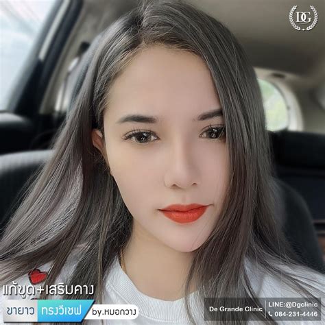 💞 รีวิวความสวย กับเคสเสริมคาง ลูกสาวหมอกวาง💞 🛑 โปรโมชั่นพิเศษ เสริมคาง แถมฟรีปรับรูปหน้าให้