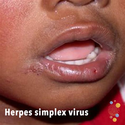 Neonatal Herpes Dont Forget The Bubbles