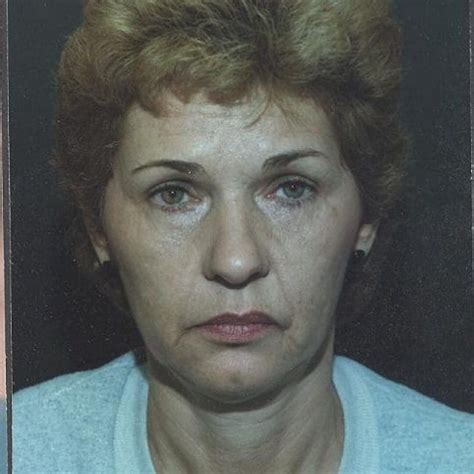 Eyelid Surgery Before After Case Female Age Dr Vitolo Plastic Surgery New