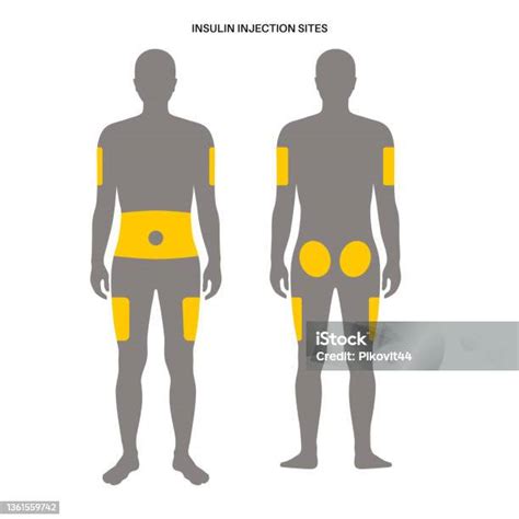 สถานที่ฉีดอินซูลิน ภาพประกอบสต็อก ดาวน์โหลดรูปภาพตอนนี้ ฉีด กิจกรรม เข็มฉีดยา เนื้อเยื่อ