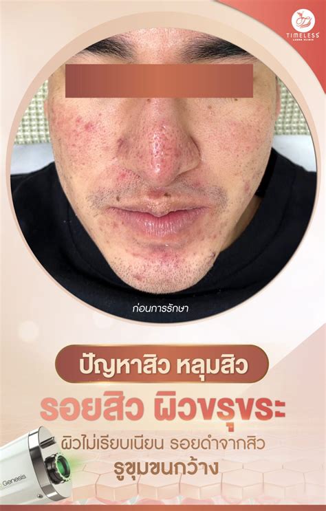 Pico Laser Enlighten Timeless Clinic