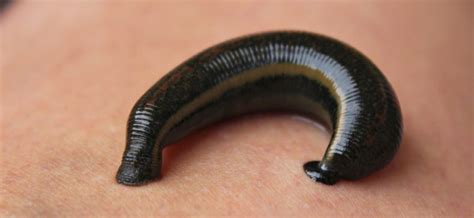 How To Remove A Leech And Treat The Bite