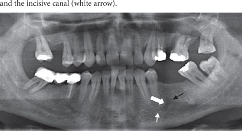 Figure 1 From Anterior Loop Of The Mental Nerve And Its Radiologic