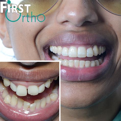 Severe Crowding First Ortho