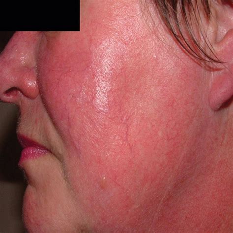 Staffordshire Skin Transformations Staffordshire Skin And Laser Clinic