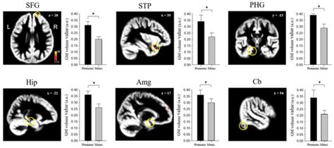 Altered Sexual Response Related Functional Connectivity And Morphometric Changes Influenced By