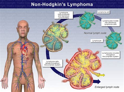 Non Hodgkins Lymphoma