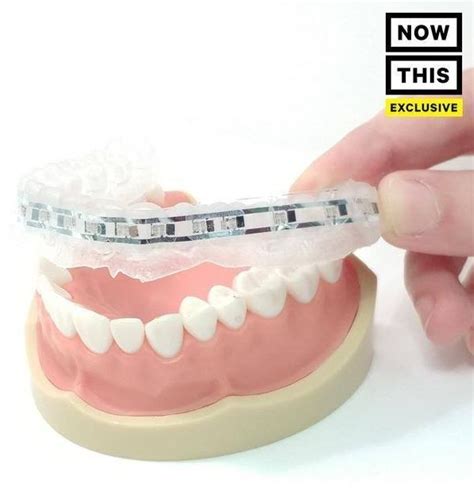 Smart Braces Cut Cost And Time In Half