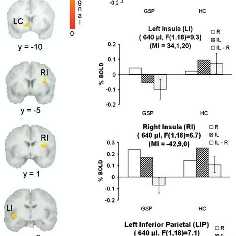 Whole Brain Analysis Demonstrating Brain Regions Where The Implicit
