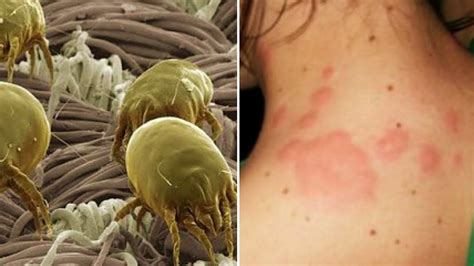 Can Heat Kill Scabies Mites At Broderick Evenson Blog