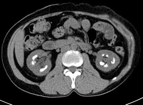 Medullary Nephrocalcinosis Radiology Cases