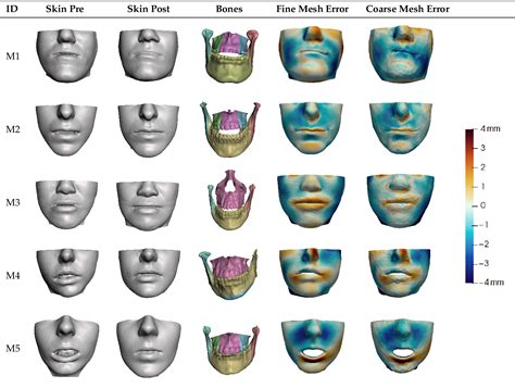 Table 2 From Soft Tissue Simulation For Computational Planning Of Orthognathic Surgery