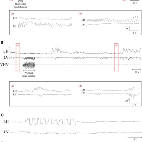 Effects Of Head Shaking And Imaginary Saccades On Ocular Flutter After Download Scientific
