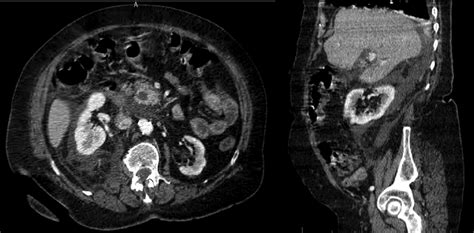 Retroperitoneal Fluid Collection Download Scientific Diagram