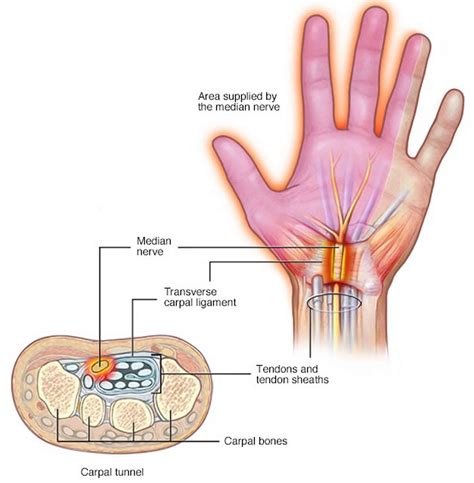 Nerve Compression Causes Symptoms Diagnosis And Treatment