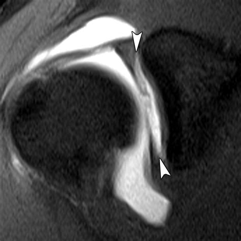 Imaging The Glenoid Labrum And Labral Tears Radiographics