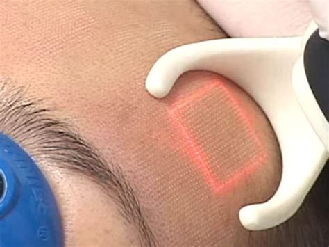 doe for fractional laser aesthetic treatments holo or