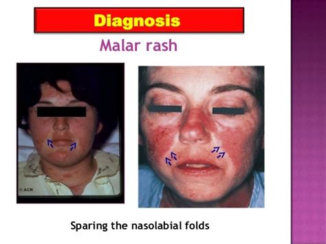 Lupus Nephritis Post Fff Lupus Nephritis Post Fff