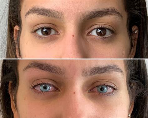 Eye Color Change Surgery Goes Viral