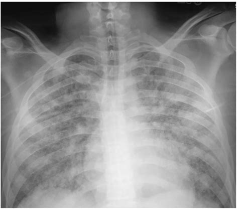 During The Evaluation Of A Patient With Suspected Fat Embolus Syndrome Download Scientific