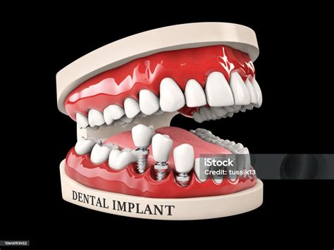 인간의 치아와 임 플 란 트 절연 블랙의 3d 그림 강철에 대한 스톡 사진 및 기타 이미지 강철 골절 나사 Istock
