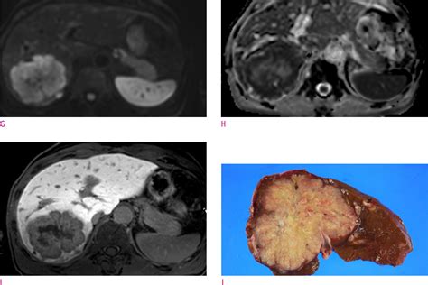 [pdf] Review Of Mass Forming Intrahepatic Cholangiocarcinoma Semantic Scholar