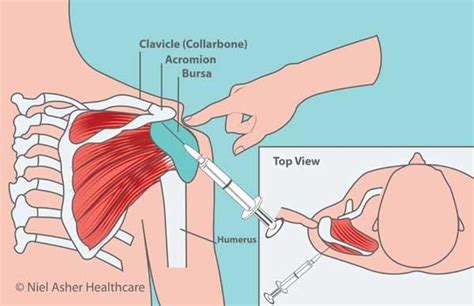 Shoulder Pain Advice By Adelaide Physio MyPhysioSA