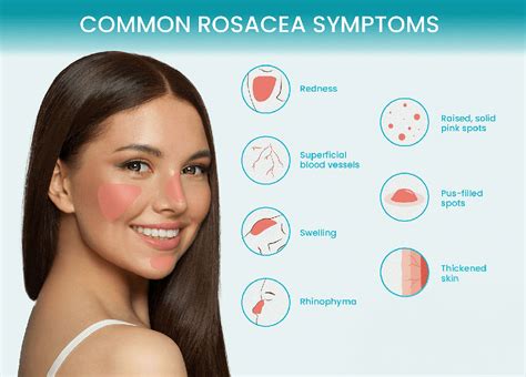 Rosacea Awareness Month Understanding Redness Triggers And Treatment Options